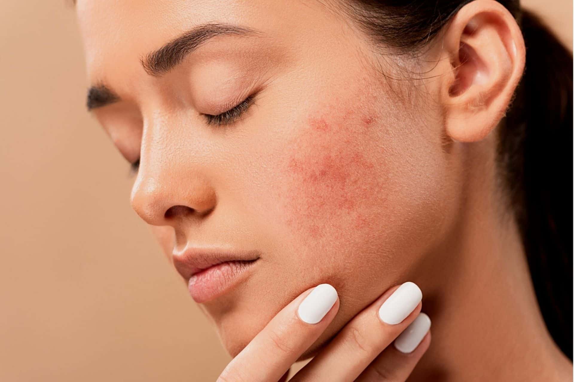 Struggling With Hormonal Acne Why It Happens And How To Treat It Dr Struggling With Hormonal Acne Why It Happens And How To Treat It Dr